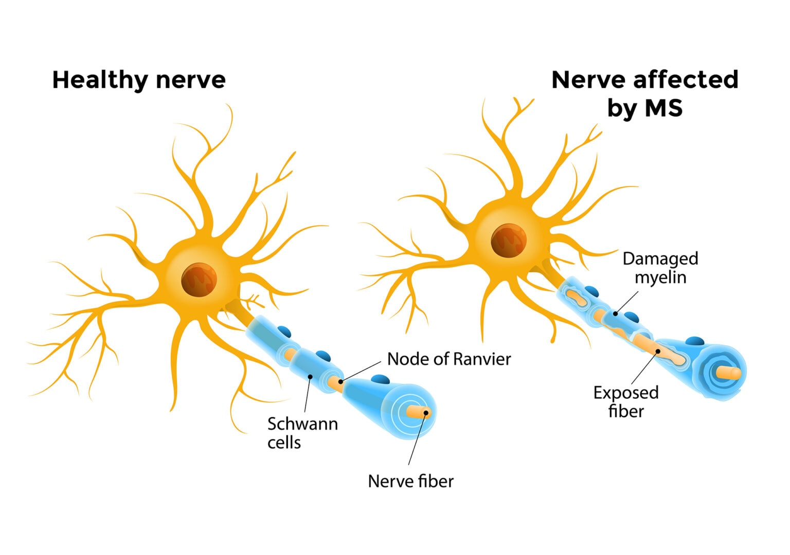 What Is MS? | MS Disease > Multiple Sclerosis NZ