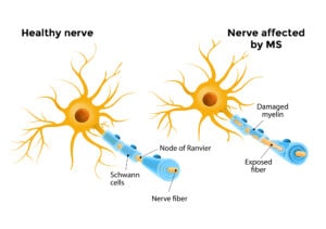 What Is MS? | MS Disease > Multiple Sclerosis NZ